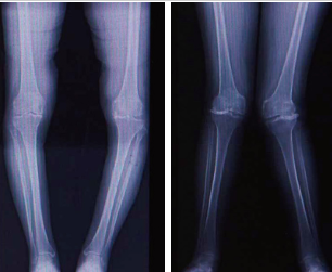 Effective Insole Therapy for Knee and Foot Pain Caused by Genu Valgum ...