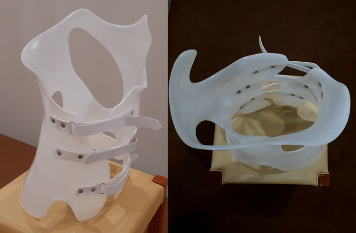 The Evolution of Bracing Therapy: A New Three-Dimensional Approach with ...